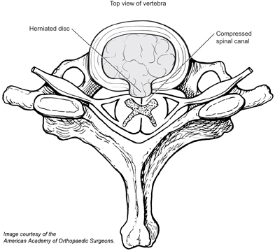 Disc Herniation (Slipped Disc) | Genesis Orthopedics & Sports Medicine