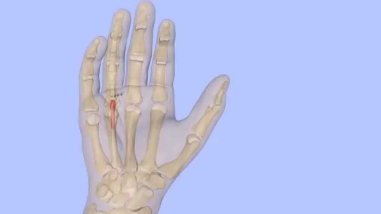 Trigger Finger Release | Genesis Orthopedic & Sport Medicine